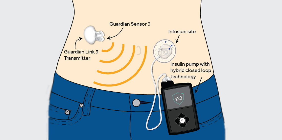 MiniMed™ 670G System von Medtronic, ab sofort bei DIASHOP erhältlich
